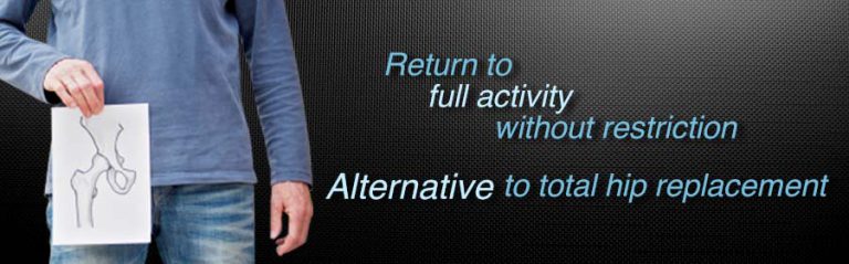 Hip Replacement Alternatives, Birmingham Hip Resurfacing | Hip Specialists